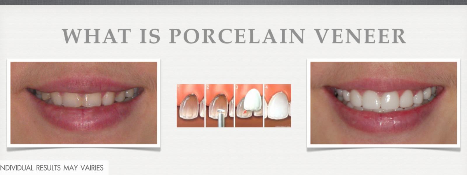 What Is Porcelain Veneer at Linda Lara blog
